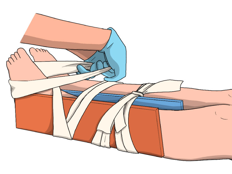 First Aid For Fractures - Vitalfour Medical
