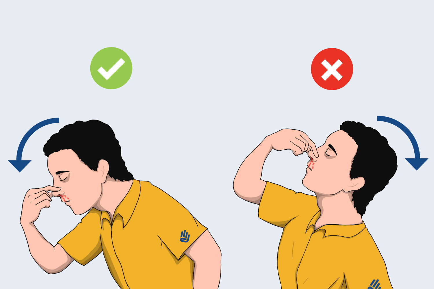 First Aid For Nosebleed - Vitalfour Medical